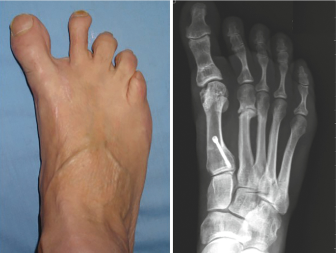 Hallux Deformities | SpringerLink