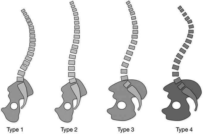 General Principles of Spinal Alignment and Balance | SpringerLink