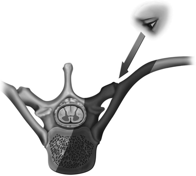 Thoracic Disc Herniation and Stenosis | SpringerLink
