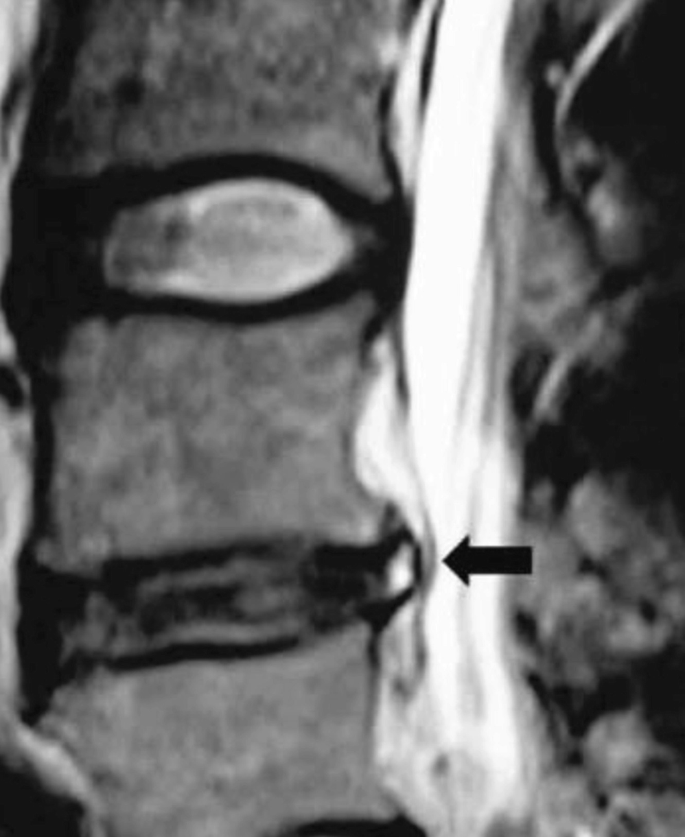 Degenerative Disc Disease | SpringerLink