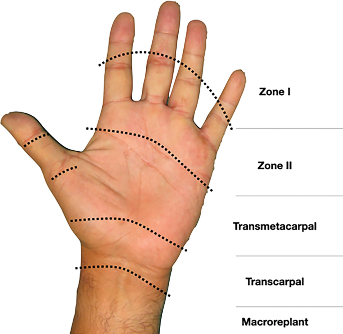 Hand and Finger Replantation | SpringerLink