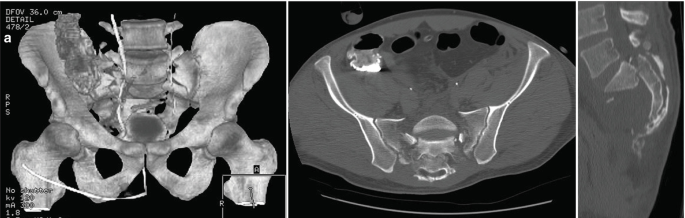 Sacral Fractures | SpringerLink