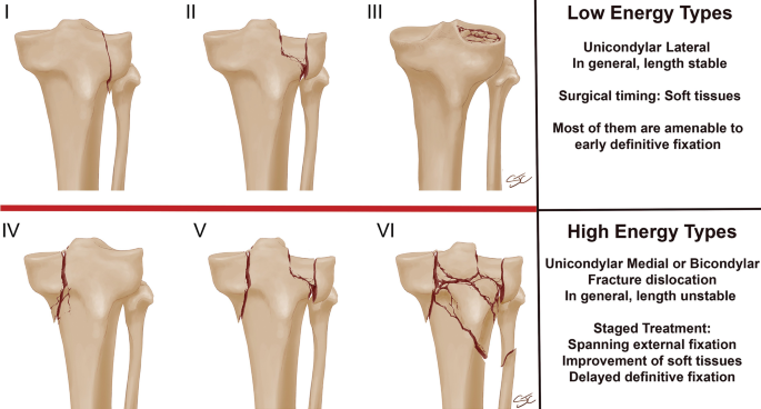 Tibial Plateau Fractures | SpringerLink