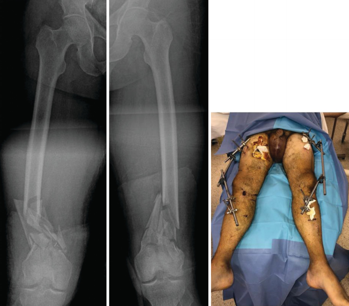 The Polytrauma Patient | SpringerLink