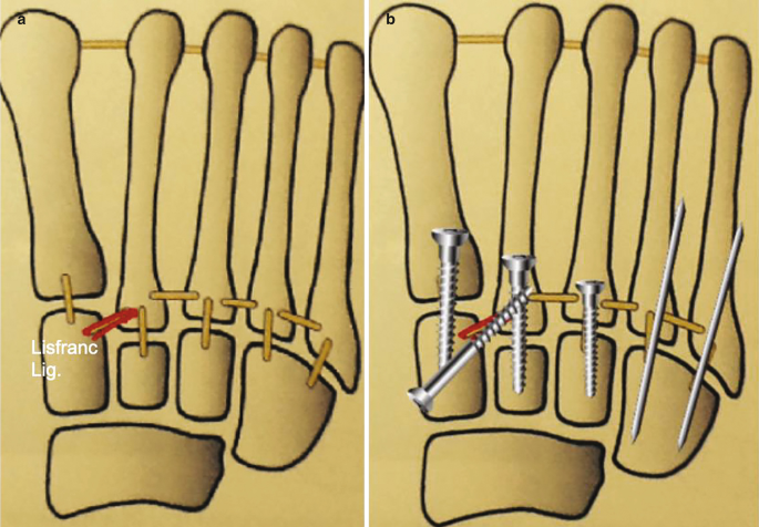 Lisfranc’s Fracture Dislocation | SpringerLink