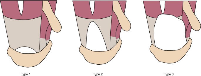 Complete Reparable Rotator Cuff Tears | SpringerLink