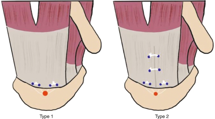Complete Reparable Rotator Cuff Tears | SpringerLink