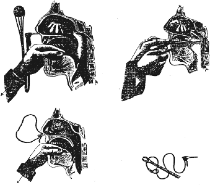 History of Nasal Polyposis | SpringerLink