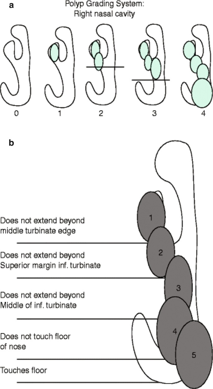 Categorization of Nasal Polyps | SpringerLink