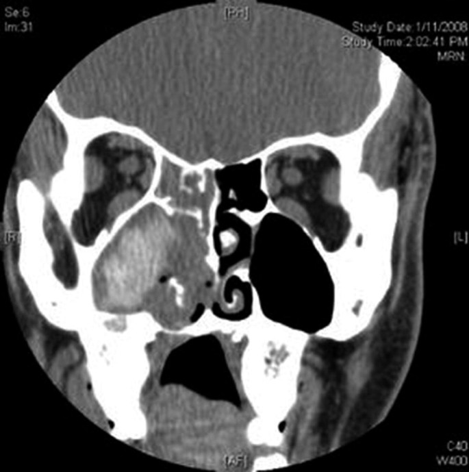 Surgical Treatment of Nasal Polyposis | SpringerLink