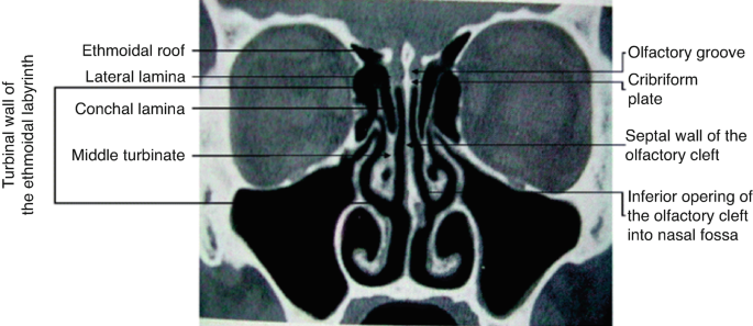 Nasalisation in the Surgical Treatment of Nasal Polyposis | SpringerLink