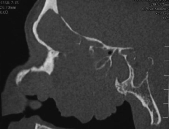 Nasal Polyposis: Aggressive Sinus Marsupialization Including the ...