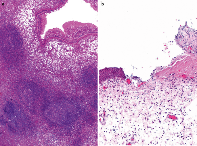 Pathology of Nasal Polyps | SpringerLink