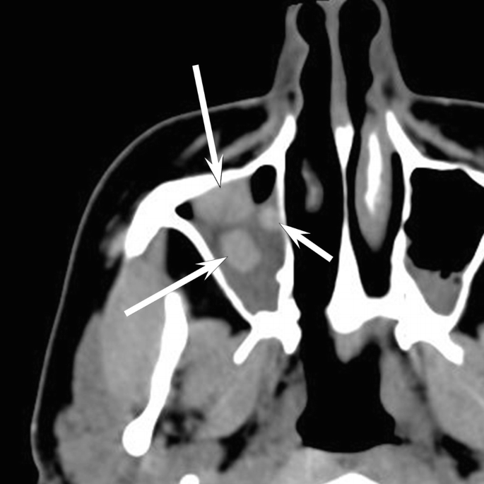 Radiologic Imaging of Nasal Polyposis | SpringerLink