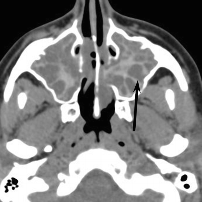 Radiologic Imaging of Nasal Polyposis | SpringerLink