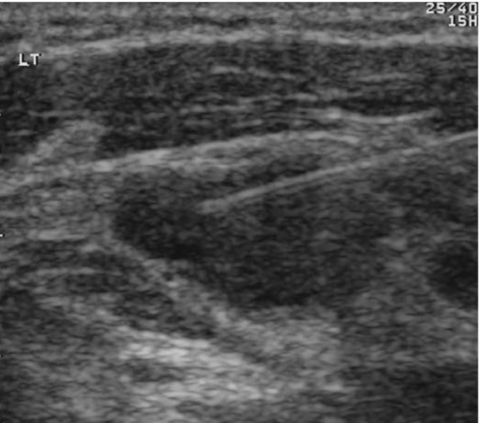 Lymph Node Excision Biopsy | SpringerLink