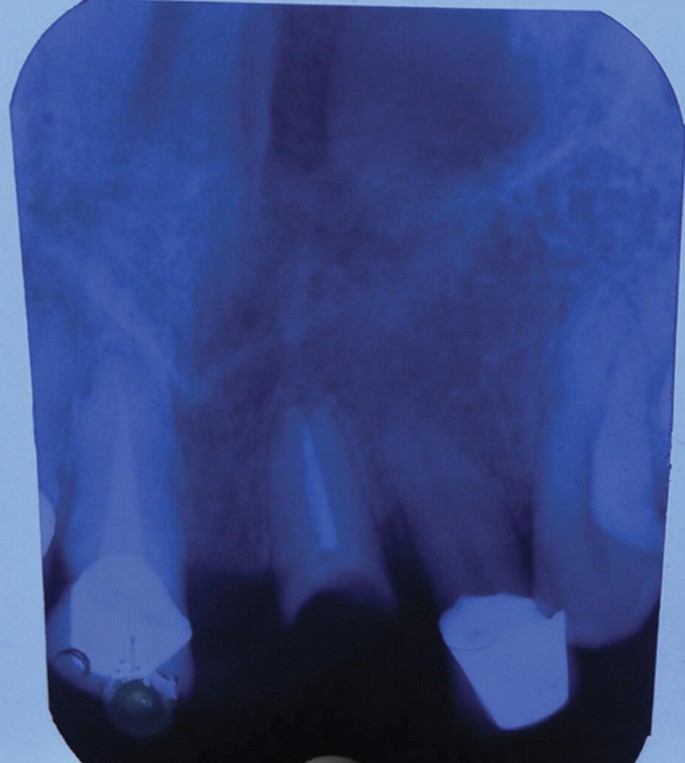 Surgical Indications for Fractured Teeth | SpringerLink