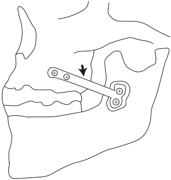 Complementary Surgical Procedure for Orthognathic Surgery | SpringerLink