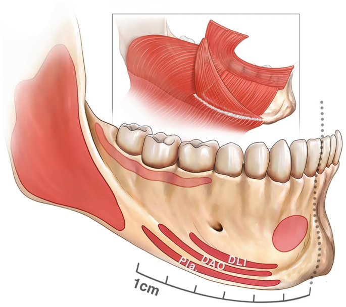 Soft Tissue Anatomy of the Lower Face and Chin | SpringerLink