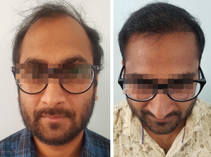 Hair Transplantation | SpringerLink