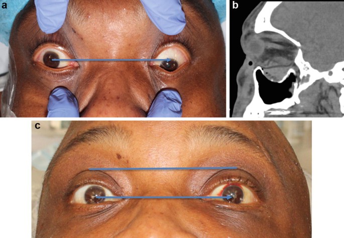 Orbital Reconstruction | SpringerLink