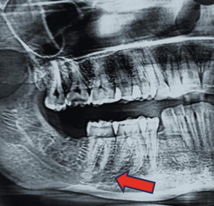 Maxillofacial Osteomylitis: Etiology, Pathogenesis, Clinical ...