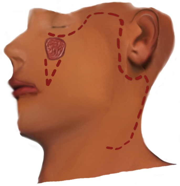 Cheek and Neck Reconstruction | SpringerLink