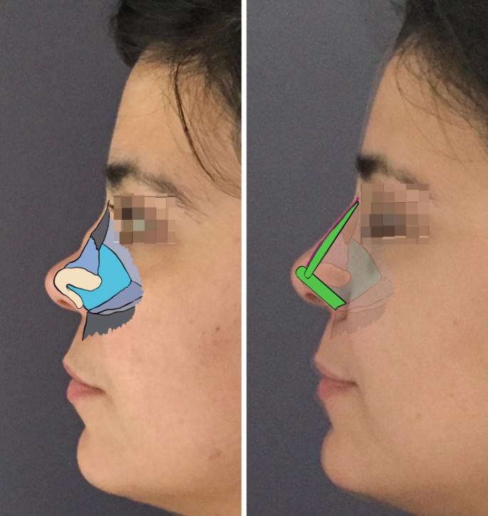 Augmentation Rhinoplasty | Springer Nature Link