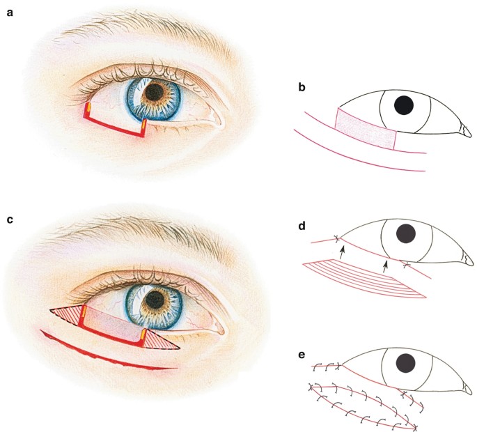 Techniques of Eyelid Reconstruction: Flaps and Grafts | SpringerLink