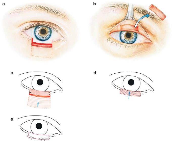 Techniques of Eyelid Reconstruction: Flaps and Grafts | SpringerLink