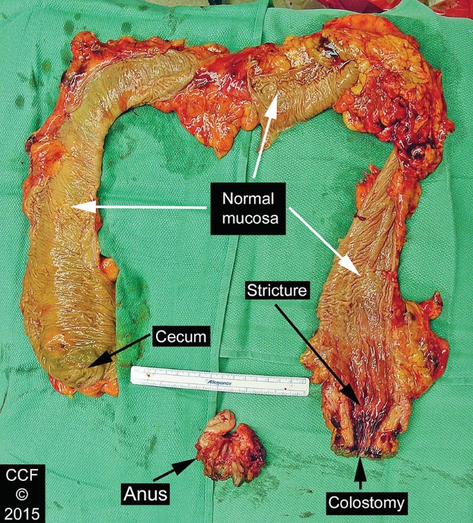 Proctosigmoiditis | SpringerLink