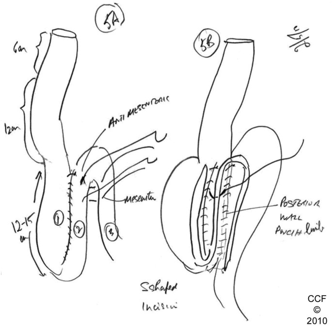 Continent Ileostomy: Victor W. Fazio Concept Illustrations | SpringerLink