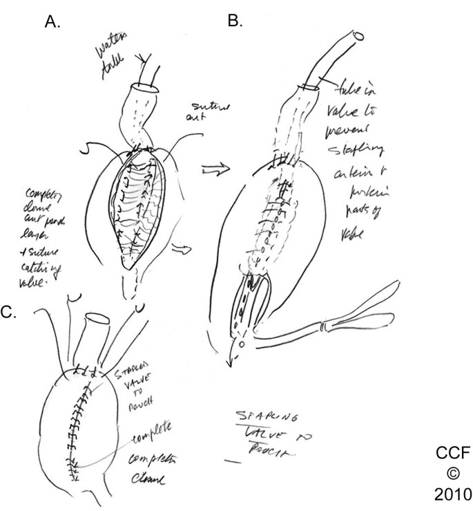 Continent Ileostomy: Victor W. Fazio Concept Illustrations | SpringerLink