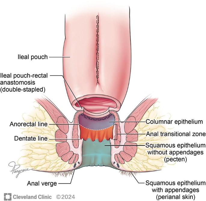 Pouchoscopy: Double-Stapled J-Pouch to Rectum Anastomosis | SpringerLink