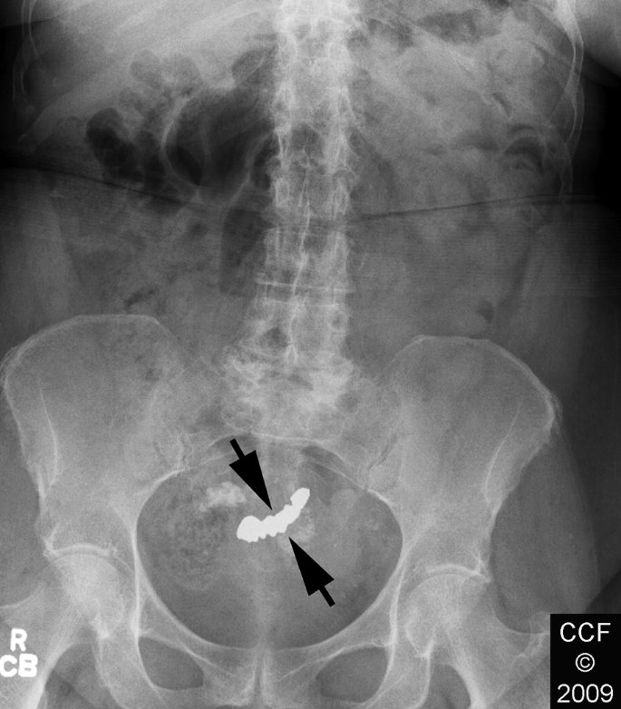 Intestinal Foreign Bodies | SpringerLink