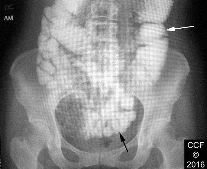 Small Bowel Obstruction, Adhesive | Springer Nature Link
