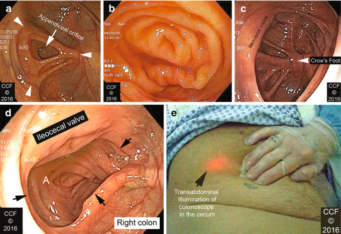 Colonoscopy-Normal Landmarks | SpringerLink