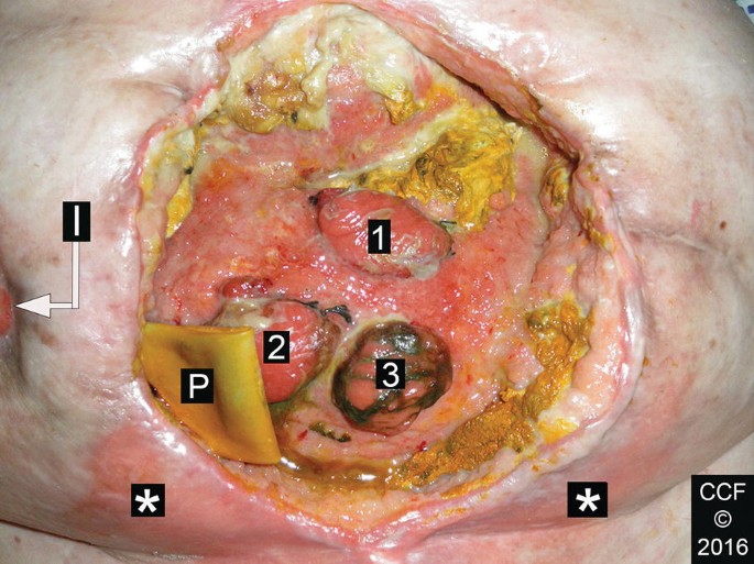 Enterocutaneous Fistula-Pouching | SpringerLink