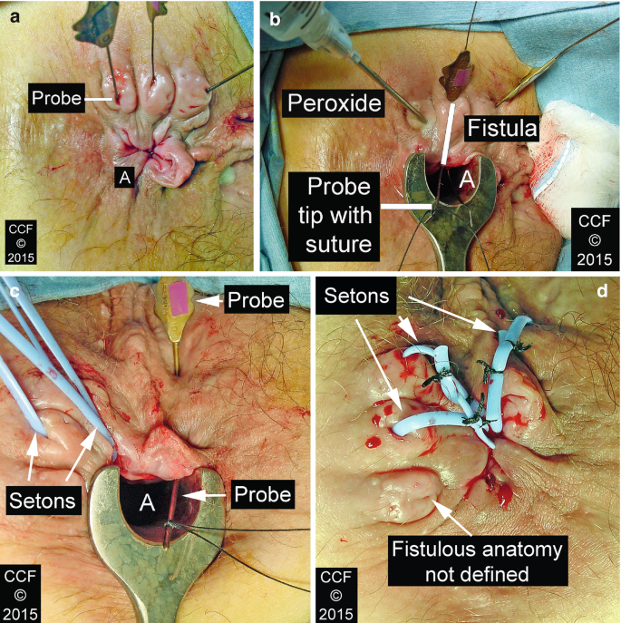 Anal Fistula-Crohn’s Disease | SpringerLink