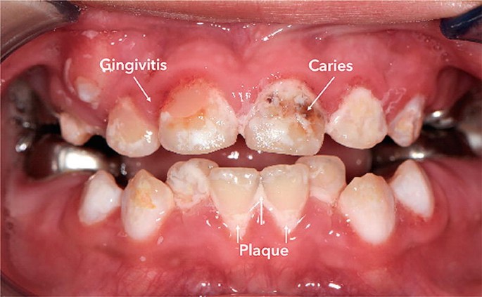 Dental Care for Children with Autism Spectrum Disorder: Challenges and ...