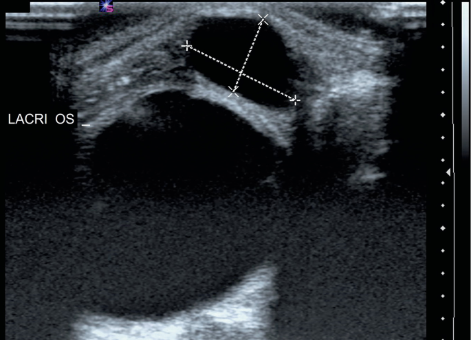 Masses of the Lacrimal Fossa | SpringerLink