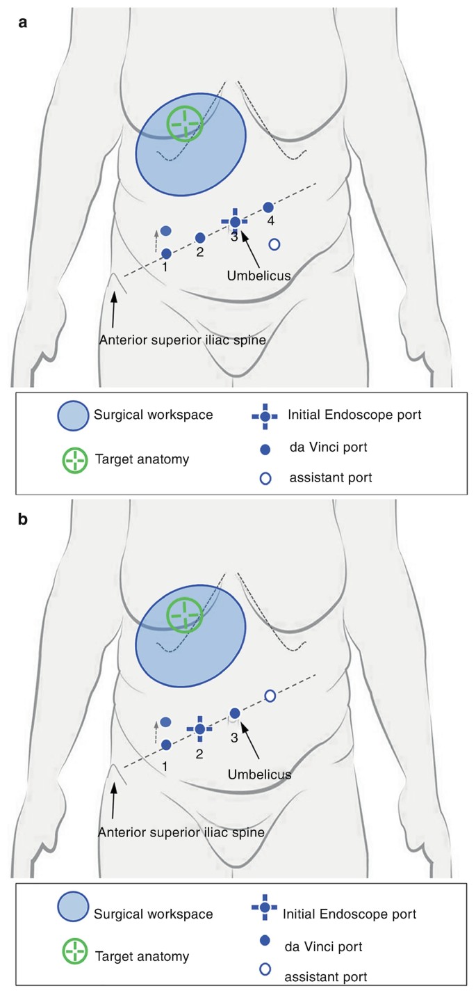 Robotic Treatment of Gallbladder Diseases | SpringerLink