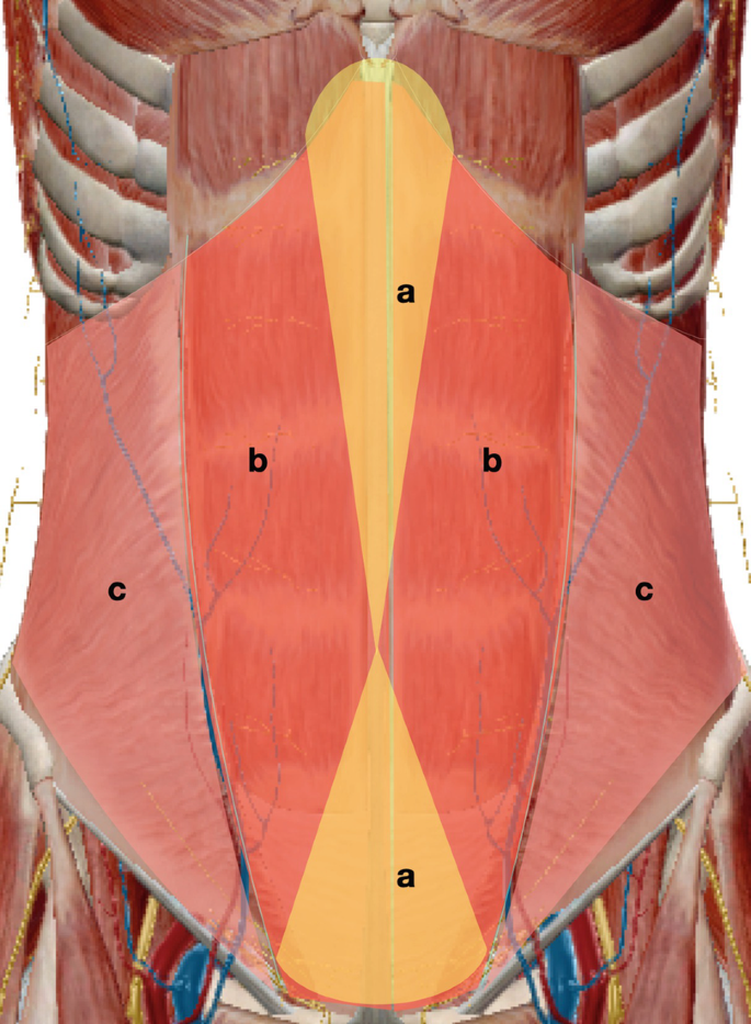 eTep Treatment of Ventral Hernia | SpringerLink