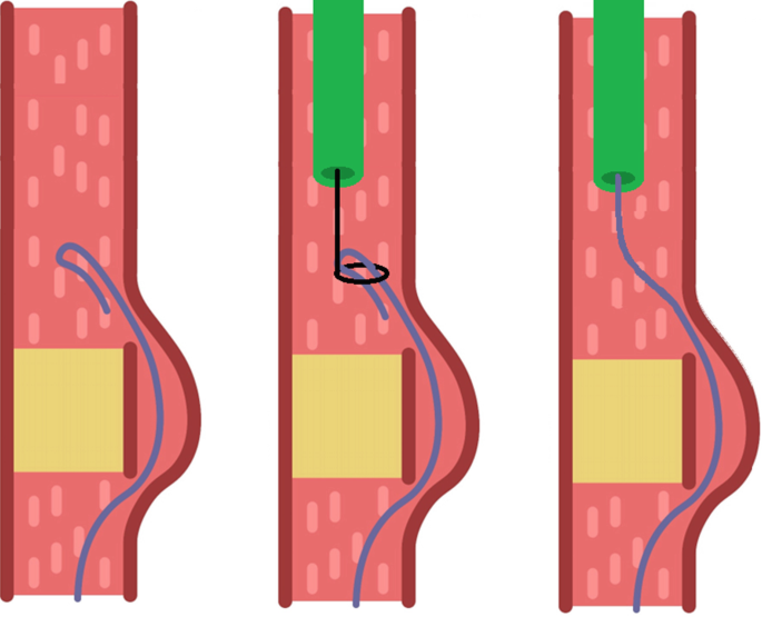 Re-Entry and Recanalisation Techniques in the Endovascular Management ...