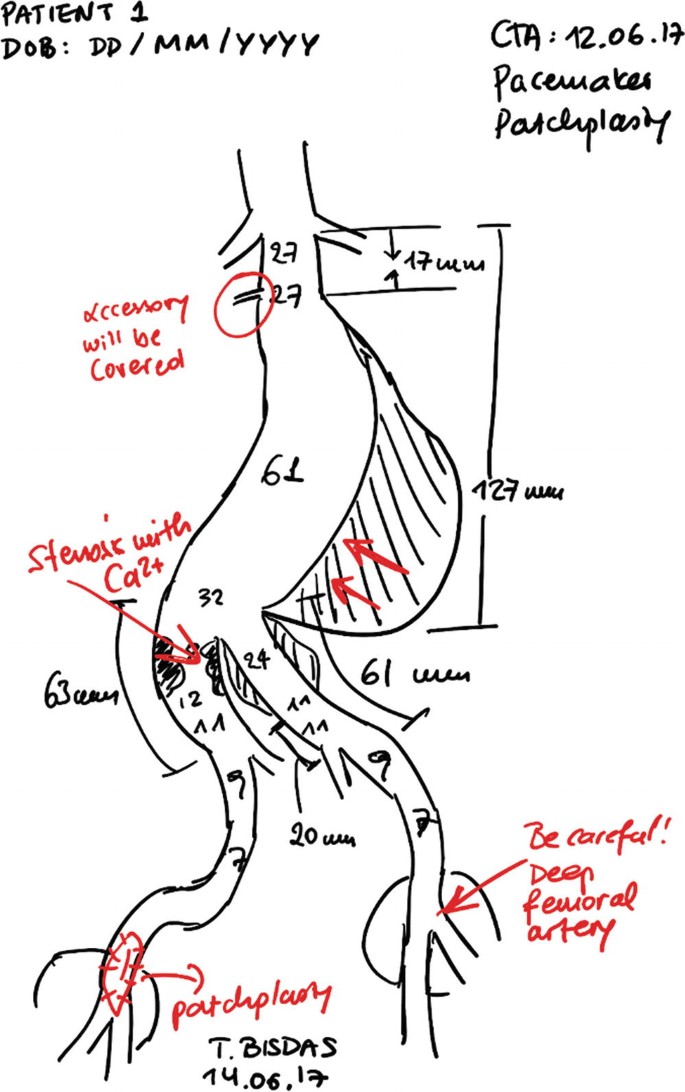 Preprocedural Planning and Measurements for EVAR | SpringerLink