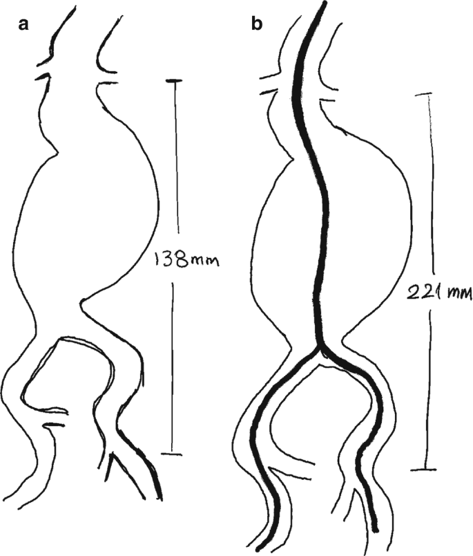 Preprocedural Planning and Measurements for EVAR | SpringerLink