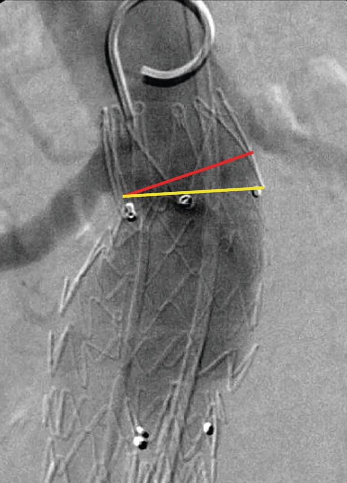 Preprocedural Planning and Measurements for EVAR | SpringerLink
