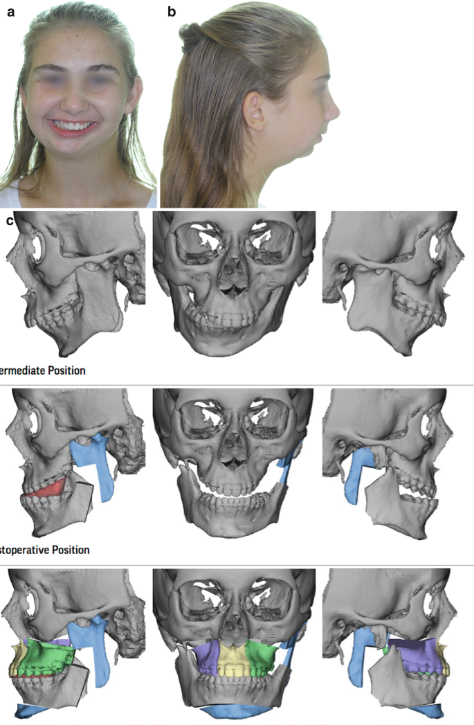 3D Printing in Oral and Maxillofacial Surgery | SpringerLink