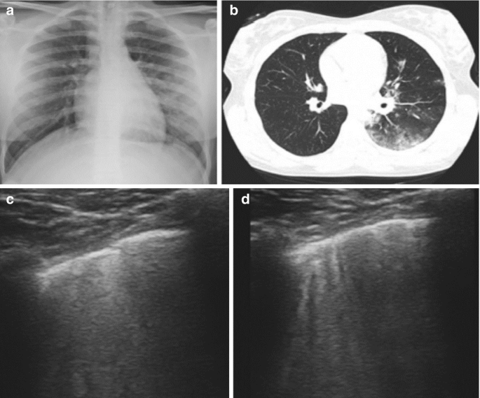 Point-of-Care Ultrasound (POCUS) in Pediatric Age: Update | SpringerLink
