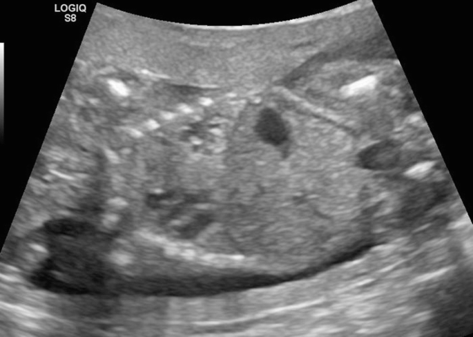 Point-of-Care Ultrasound (POCUS) in Pediatric Age: Update | SpringerLink